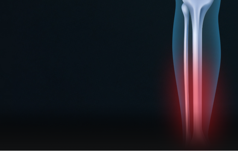 Distal Tibia Plate - Sorath Ortho
