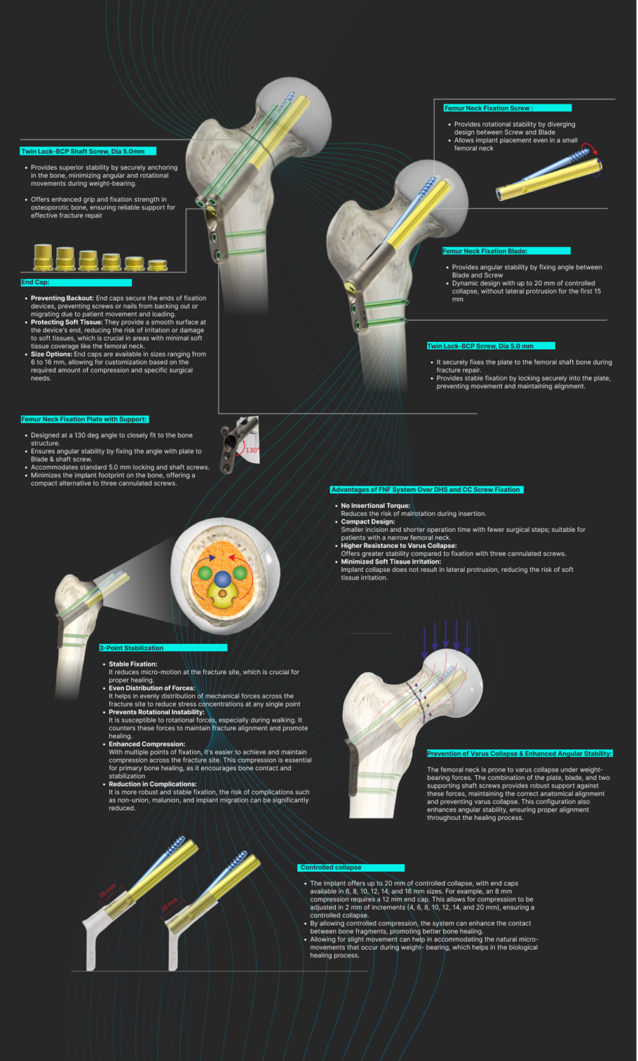 Femur Neck Fixation - Sorath Ortho